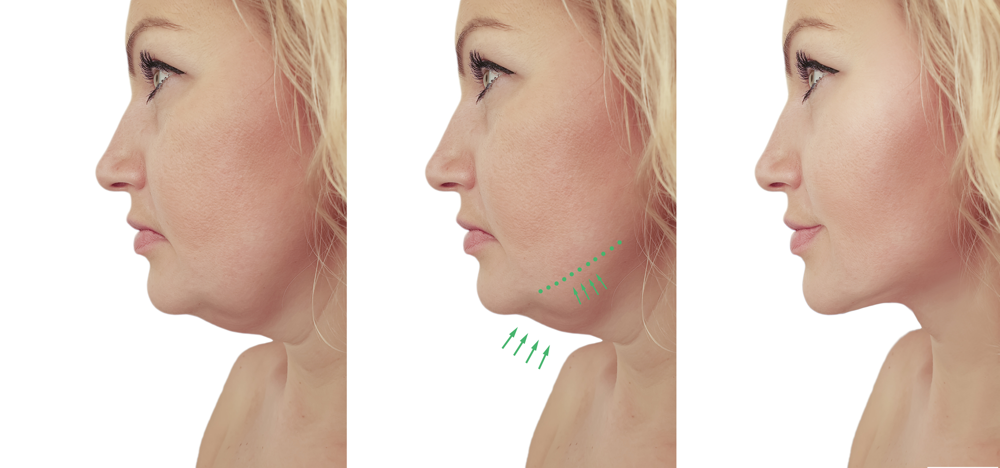AccuTite (Double Chin) - RICHMOND LASER & COSMETIC